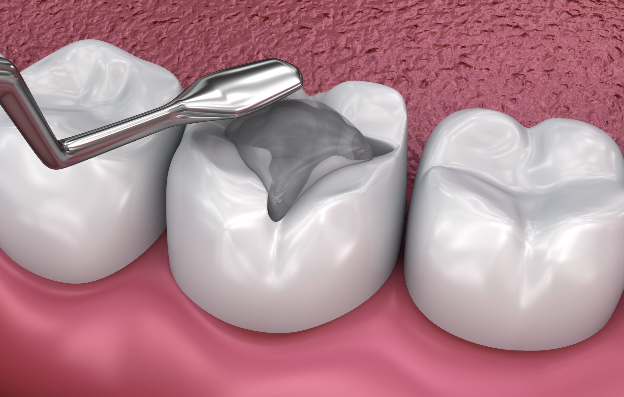 Treating Your Cavities With Fillings | Rochester, MN