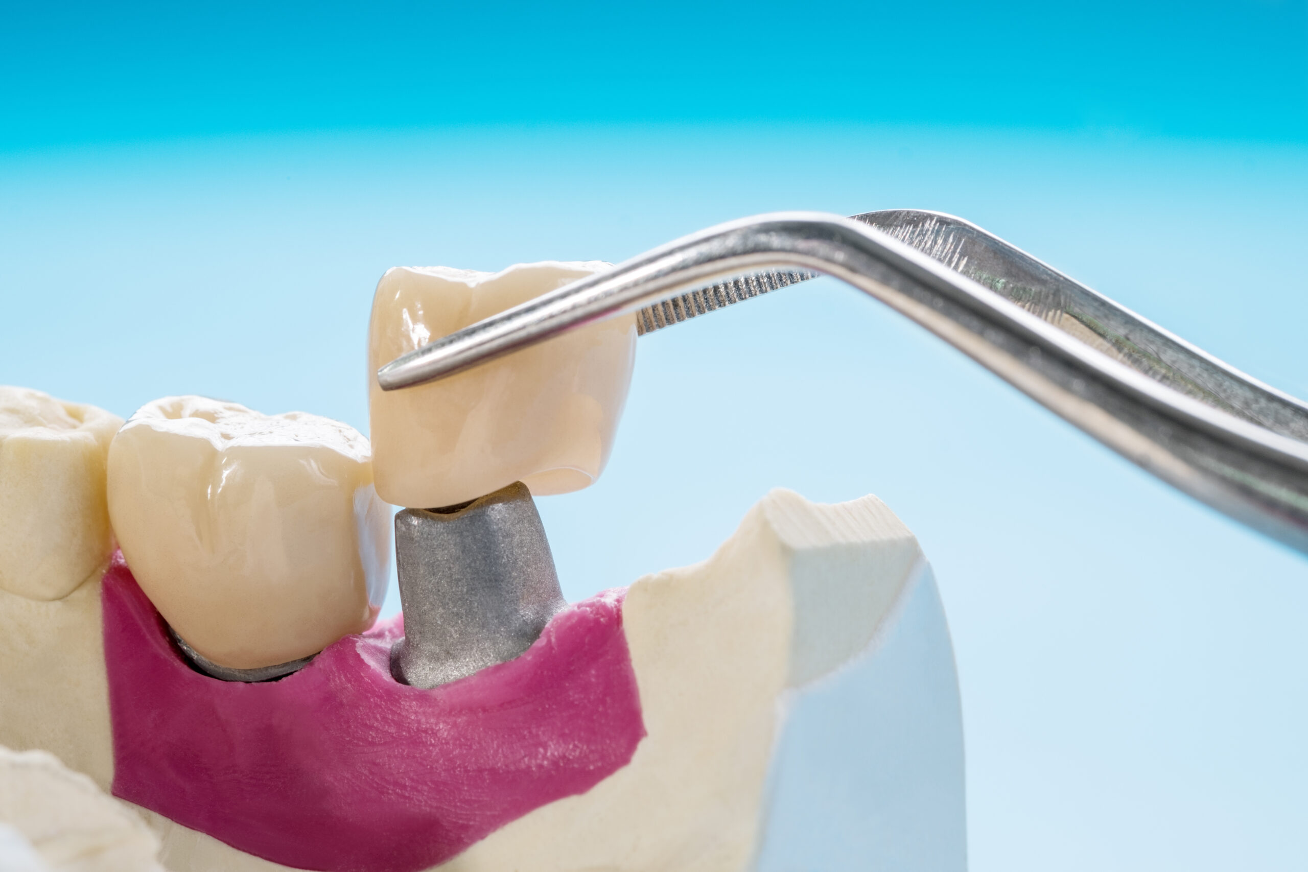 Creating Crowns That Look Natural | Rochester, MN