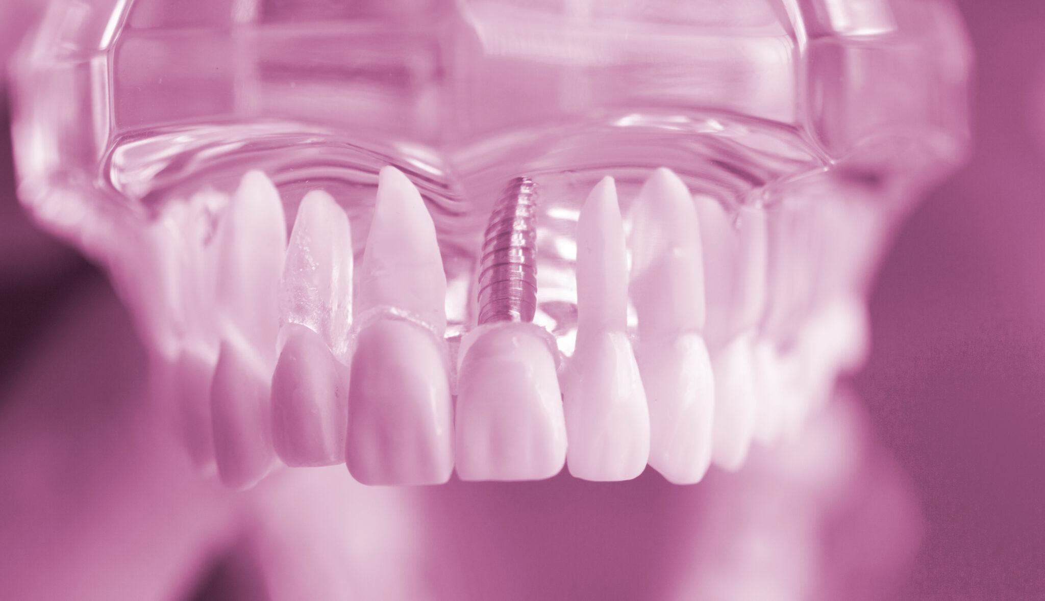Dental Implants | Greenview Cosmetic and Family Dentistry