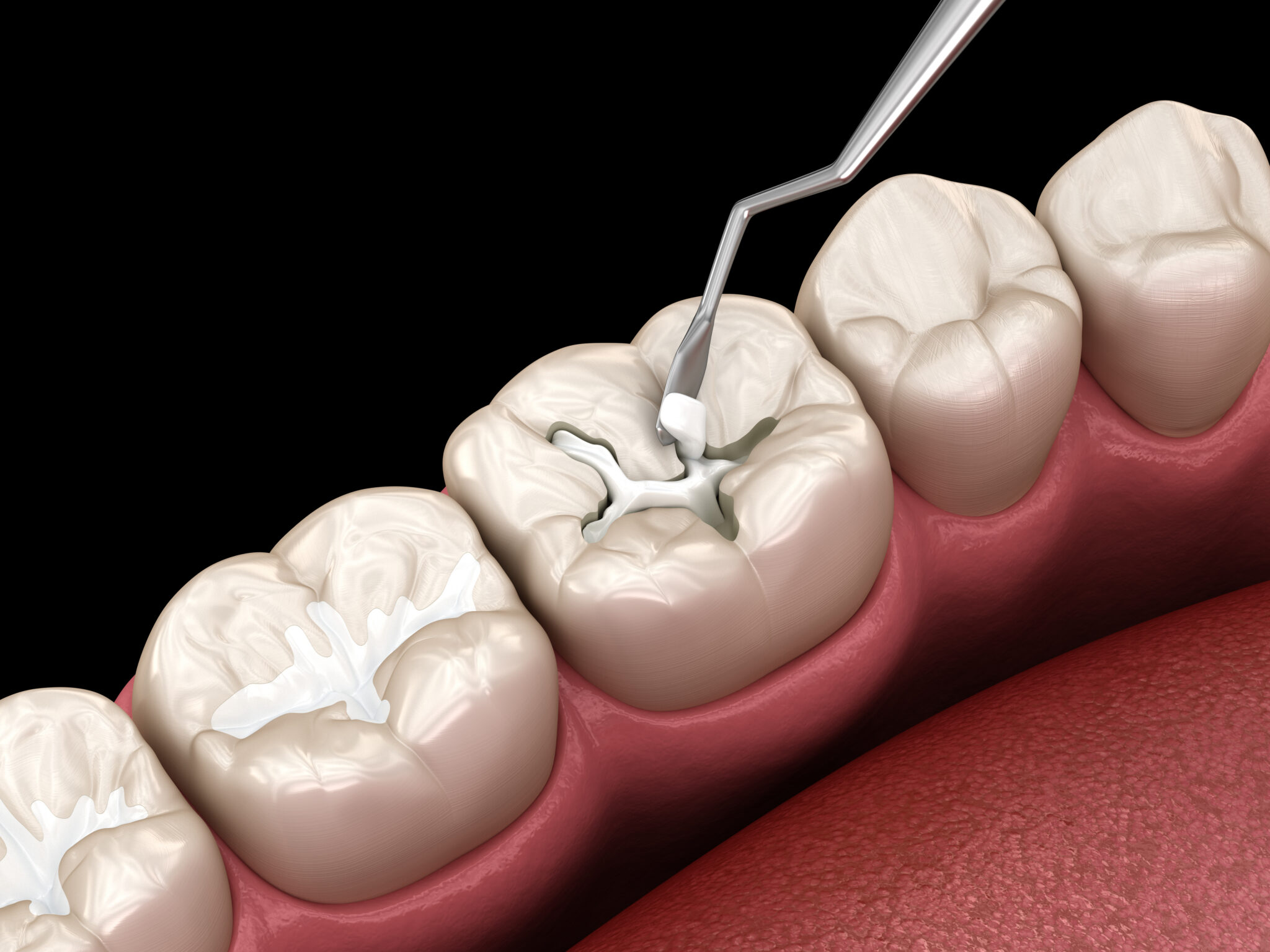 How Our Fillings Imitate Tooth Structure | Rochester, MN
