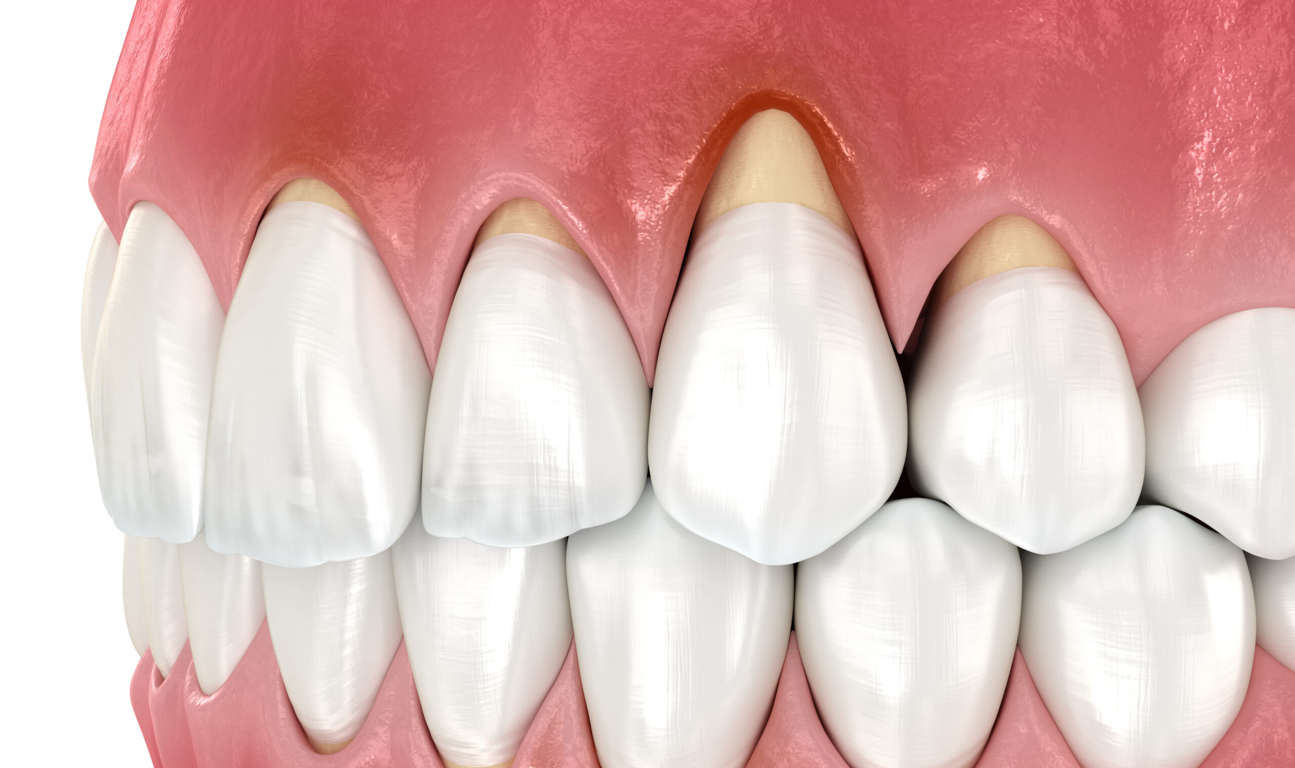 Protecting Your Gums from Recession | Rochester, MN