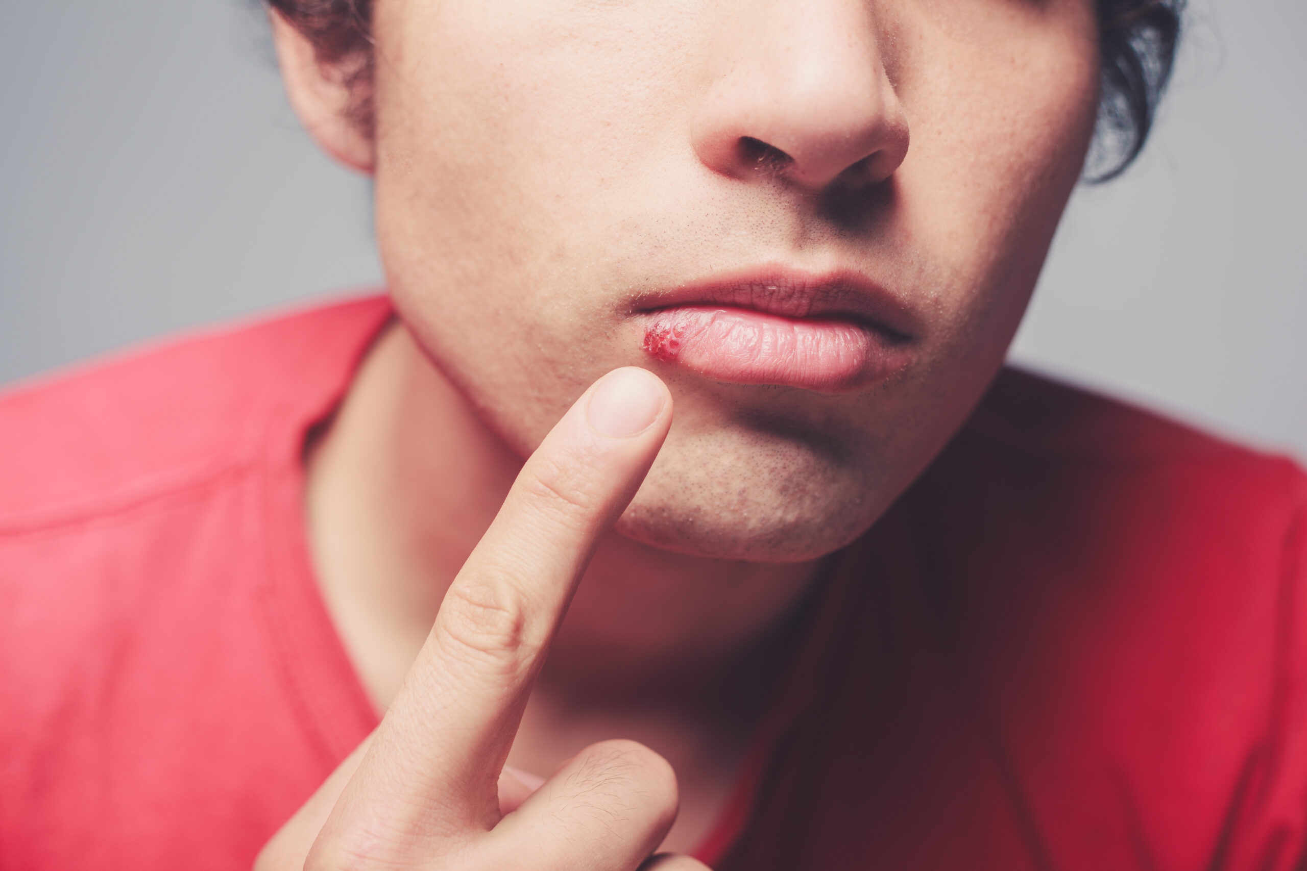 Get Rid Of Cold Sores Quickly With Laser Treatment